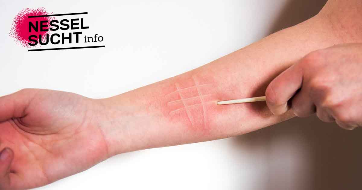 Kleidung bei Nesselsucht – darauf solltest du achten | nesselsuchtinfo.de