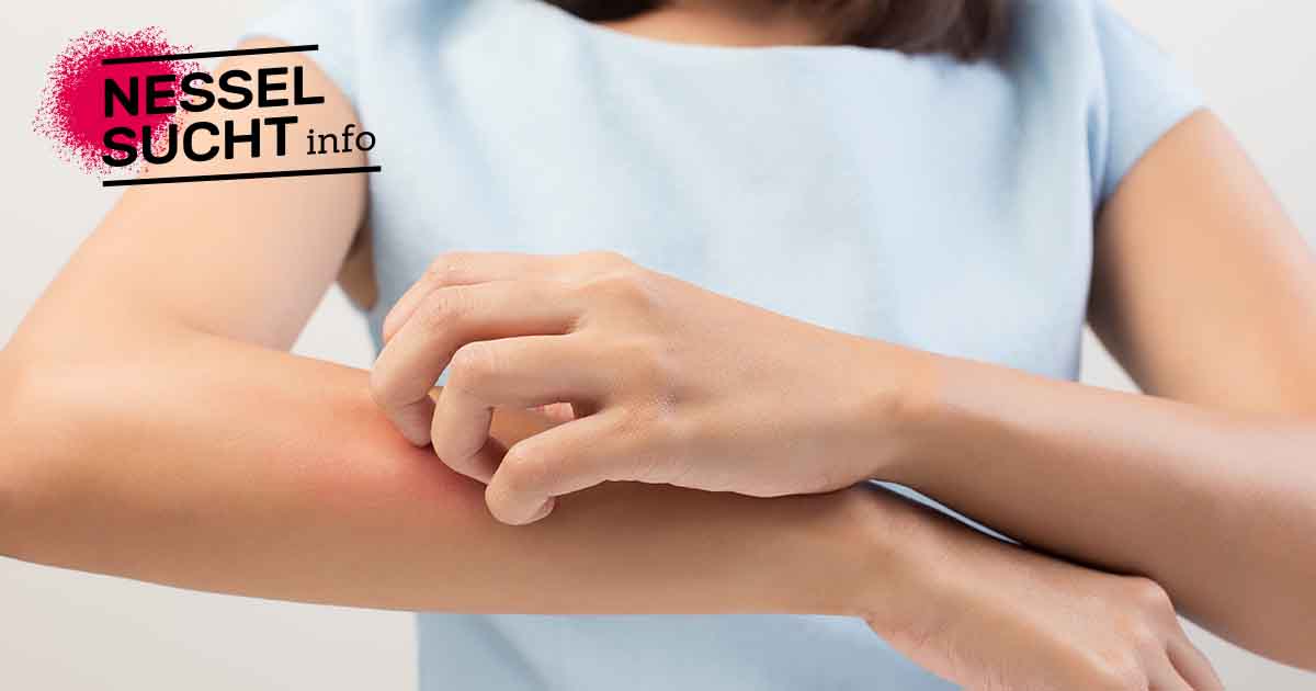 Nesselsucht-Test: Hinweise auf Urtikaria? | nesselsuchtinfo.de