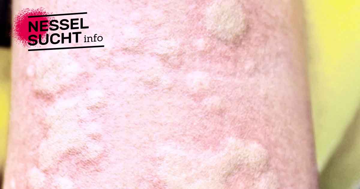 Nesselsucht – Hilfe & Tipps bei Urtikaria | nesselsuchtinfo.de