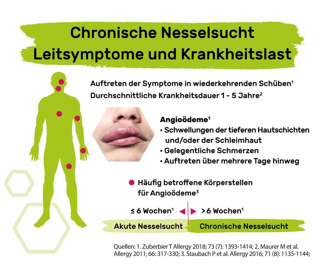 Chronische spontane Nesselsucht – plötzliche Hautsymptome ...