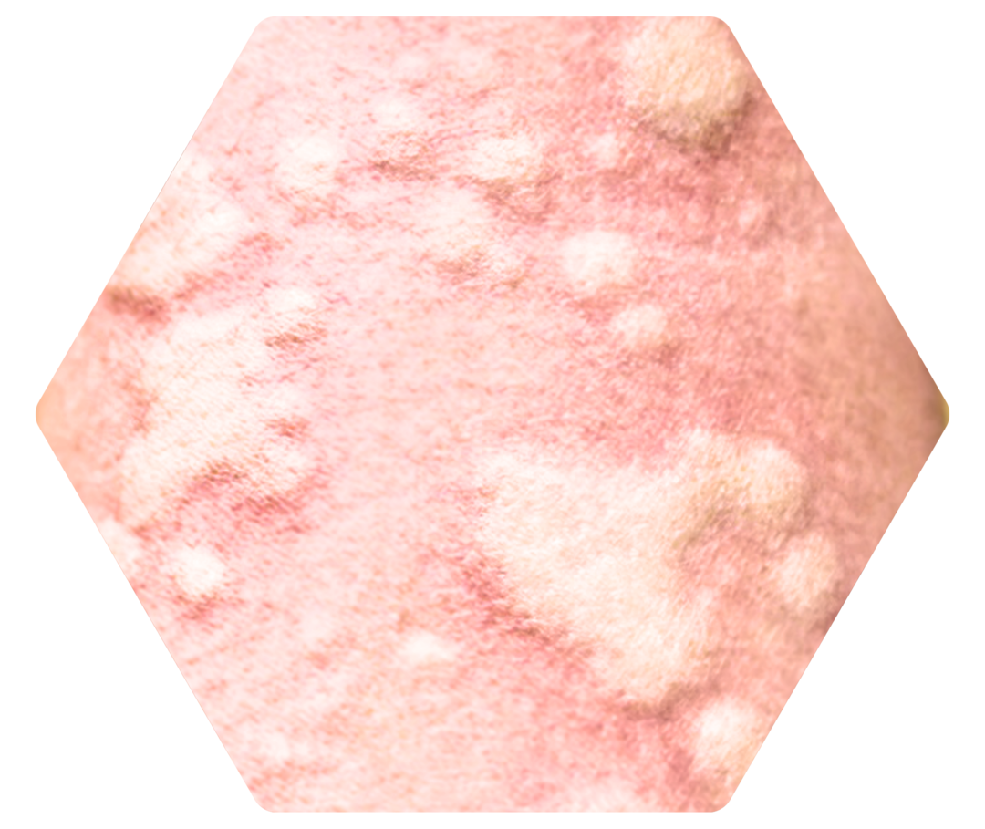 Chronische induzierbare Urtikaria | nesselsuchtinfo.de